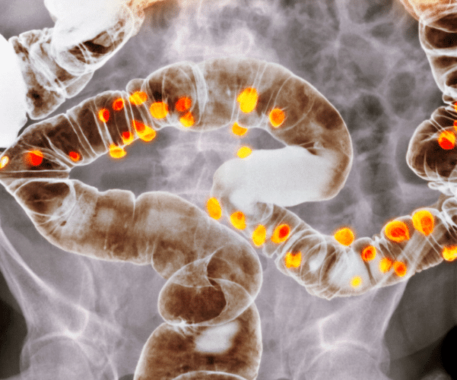 ΠΑΧΥ ΕΝΤΕΡΟ - ΣΚΩΛΙΚΟΕΙΔΗΣ - Γενικος Χειρουργος, Αριστοτελης Κεχαγιας