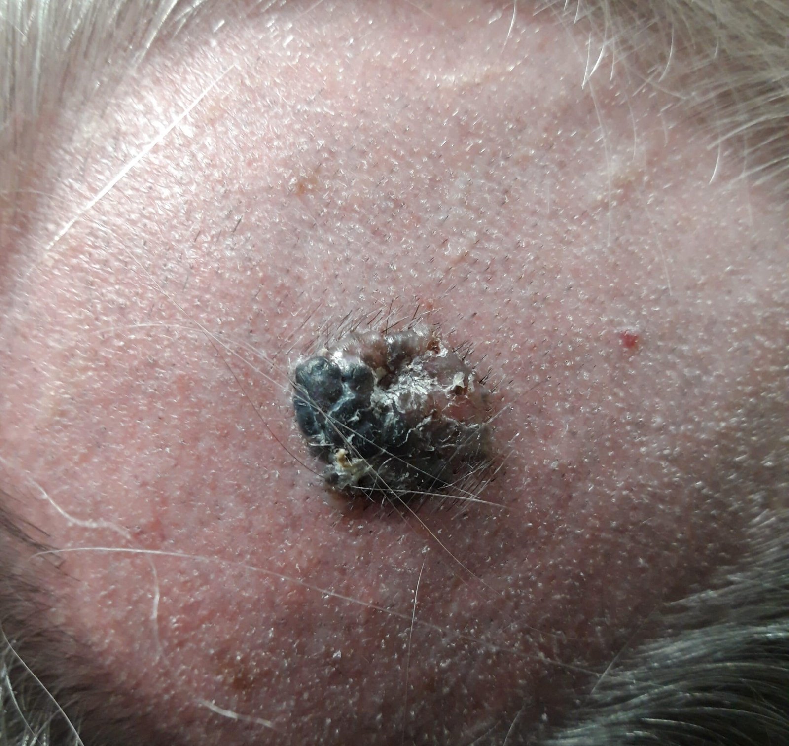 ΚΑΡΚΙΝΟΣ ΔΕΡΜΑΤΟΣ - Γενικος Χειρουργος, Αριστοτελης Κεχαγιας