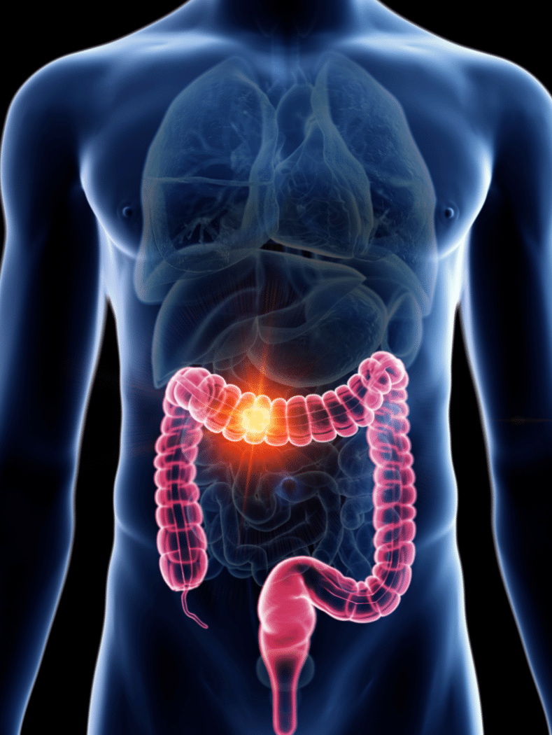 ΚΑΡΚΙΝΟΣ ΠΑΧΕΟΣ ΕΝΤΕΡΟΥ - Γενικος Χειρουργος, Αριστοτελης Κεχαγιας