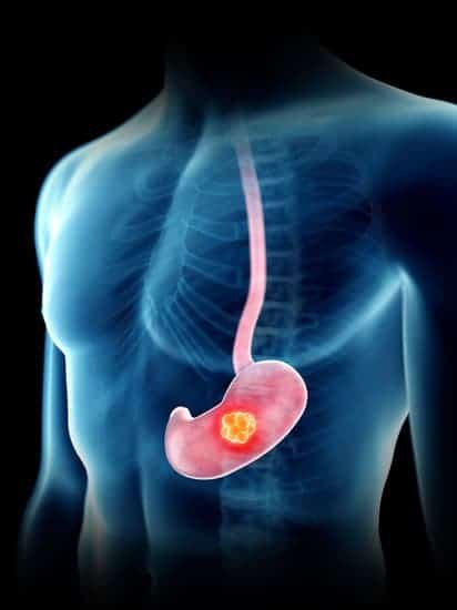 ΚΑΡΚΙΝΟΣ ΣΤΟΜΑΧΟΥ - Γενικος Χειρουργος, Αριστοτελης Κεχαγιας