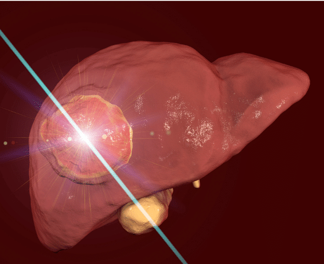 ΠΑΓΚΡΕΑΣ – ΣΠΛΗΝΑΣ - ΗΠΑΡ - Γενικος Χειρουργος, Αριστοτελης Κεχαγιας